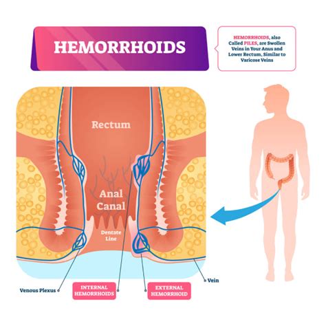Internal Vs External Hemorrhoids