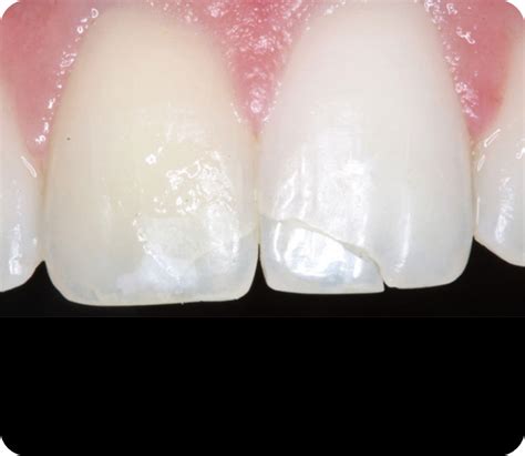Aesthetic Composite Resin Restorations Dental Implants