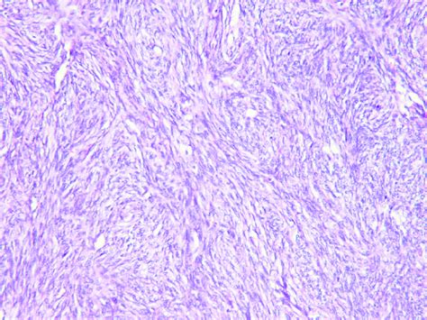 Histopathology Showed Hyper Cellular Spindle Cell With Fascicular