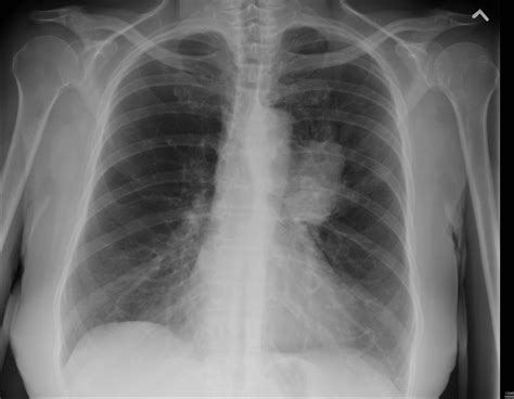 Small Cell Lung Cancer Chest X Ray