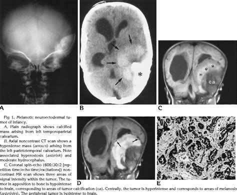 Melanotic Neuroectodermal Tumor Of Infancy