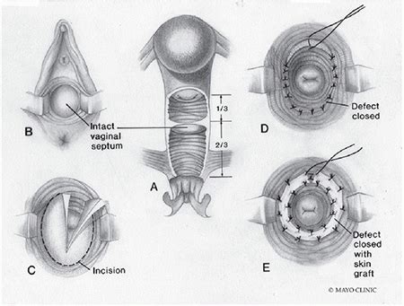 Congenital Anomalies And Creation Of The Neovagina Obgyn Key