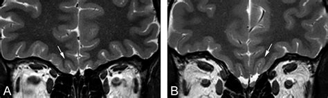 The Depth Of The Olfactory Sulcus Is An Indicator Of Congenital Anosmia