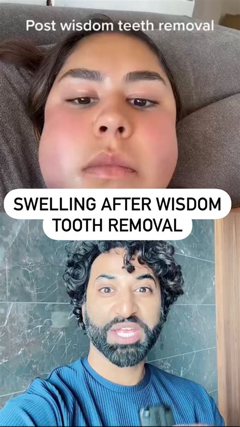 Swollen Face After Wisdom Teeth Removal