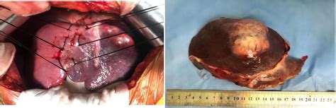 Left Hepatectomy Was Conducted And A Single Exophytic Nodule Was Download Scientific Diagram