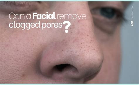Clogged Pores Treatment The Pore Facial