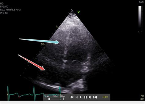Transthoracic Echocardiogram Showing Mild Left Atrial Dilation The Red
