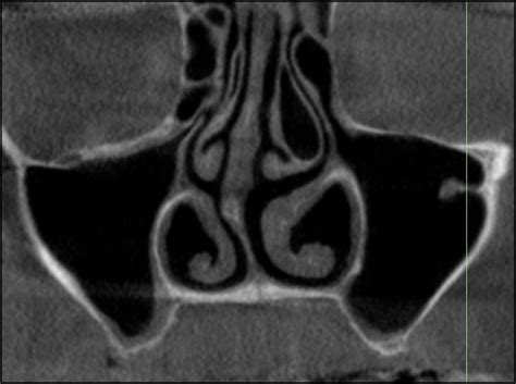 Sinus Anatomic Variants That Predispose Post Implant Morbidity