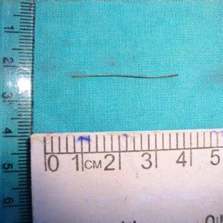 Foreign Body Post Removal Download Scientific Diagram