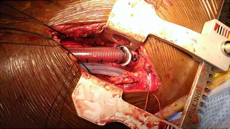 Ecmo Cannulation Techniques Intechopen