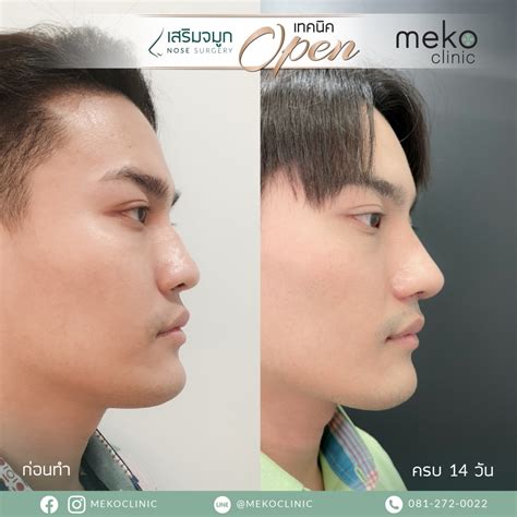 ทำความรู้จักกับการเสริมจมูกแบบ Open พร้อมข้อดี ข้อเสีย และขั้นตอนการเสริมจมูกแบบโอเพ่น Meko Clinic