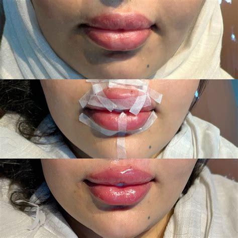 بيد الدكتورة الرائعة هبه يونس اخصائية الجلدية و التجميل 💉 Lip Strip