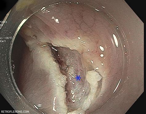 Flat “polyp” Resection Part One