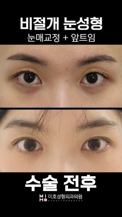비절개 쌍수 후기👀 비절개쌍꺼풀 눈매교정 앞트임 Shorts Youtube