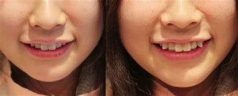 Yaeba Trend Of Crooked Teeth In Japan