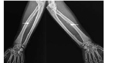 Radiograph Of The Bilateral Forearm Showing Interosseous Membrane Download Scientific Diagram