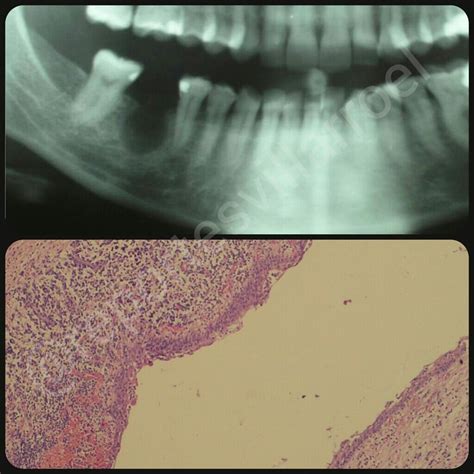 Residual Cyst