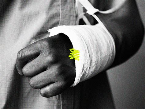 Closed Reduction Fracture What To Expect Recovery And Benefits