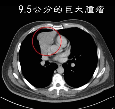 慎入！縱膈腔95cm巨型腫瘤現形