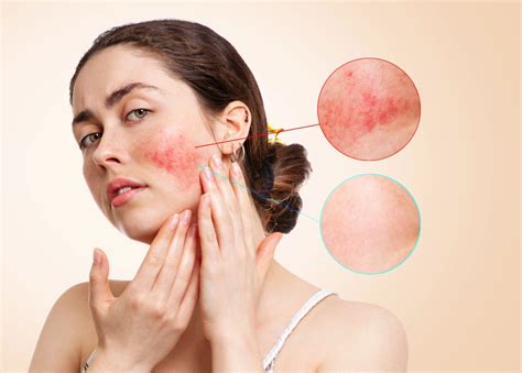 КУПЕРОЗ Причини Симптоми Профілактика Лікування