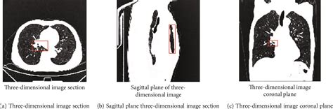 Figure 8 From Design Computer Aided Diagnosis System Based On Chest Ct Evaluation Of Pulmonary