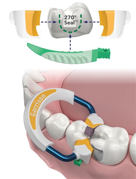 Strata G Rings Kit 3 Per Package 1 X Sg400 1 X Sg500 1 X Sg600