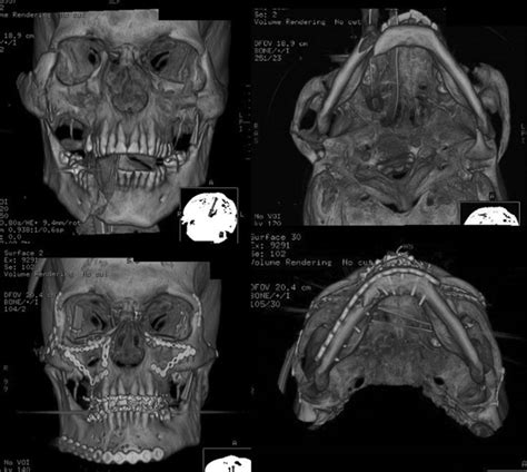 Management Of Panfacial Fracture Pmc