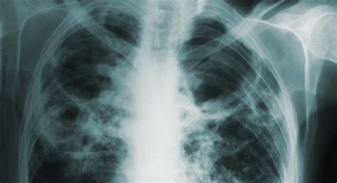 Explainable Identification Of Lung Abnormalities In Chest X Ray And Ct Imaging Leeds Institute