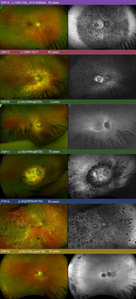 Wide Field Optos Color Left Column And Faf Right Column Fundus Download Scientific