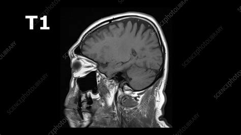 Normal Skull And Brain T1 Mri Stock Video Clip K012 2524 Science Photo Library