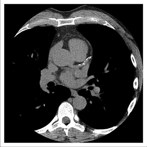 Figure Representative Computed Tomography Slice From Mesa Download Scientific Diagram