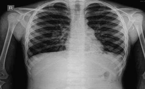 Mycobacterium Lentiflavum Infection In A Patient With Hyper Infectious Diseases In