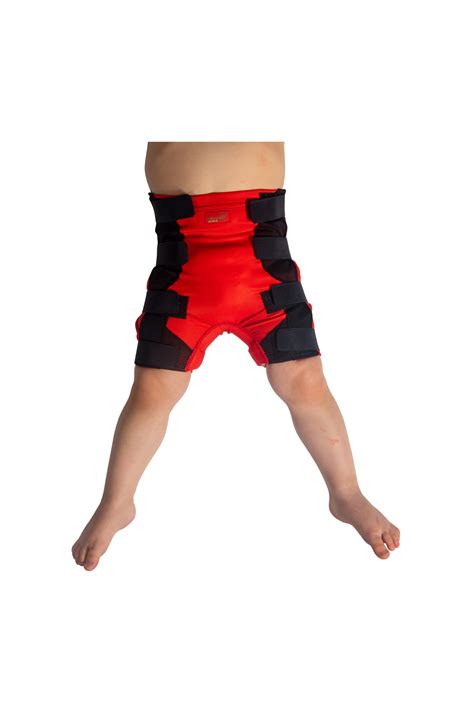 Hip Dysplasia Condition Dm Orthotics Ltd