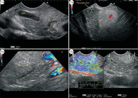 Pancreatic Divisum Ultrasound
