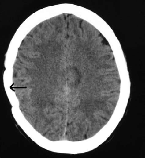 Ct Scan After 3 Months Of Surgery At The Time Of Follow Up Showing