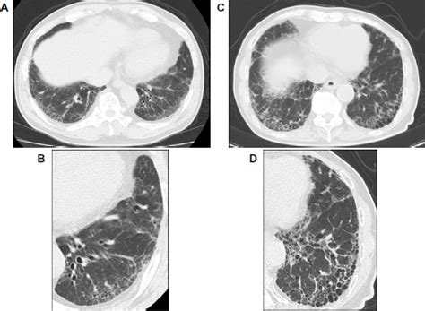 High Resolution Computed Tomography Hrct Images Demonstrating Usual