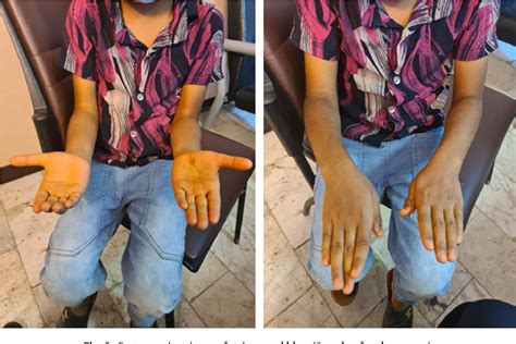 Figure 2 From Concurrent Ulnar Plastic Deformity And Ipsilateral