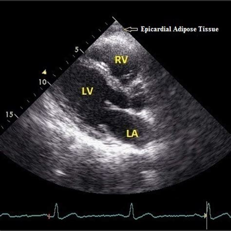 Pdf Echocardiographic Measurement Of Epicardial Adipose Tissue