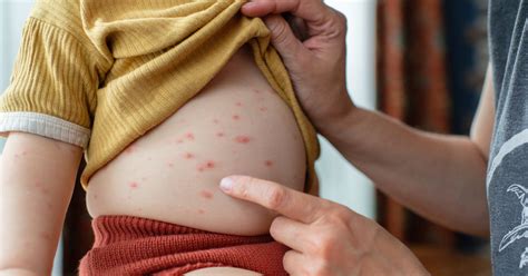 Chickenpox Varicella Symptoms Diagnosis And Treatment Nebraska