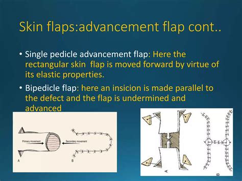 Flaps In Surgery Pptx