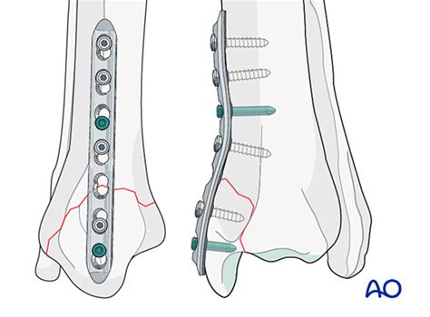 Screw Fixation Of The Medial Malleolus For Partial Articular Medial