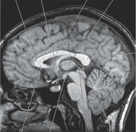 Sagittal Slice Brain Diagram Quizlet