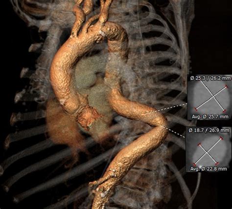 Thoracic Aorta Perforation Treated Conservatively After Tavr In A Patient With Extremely