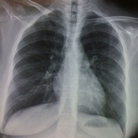 Empyema Thoracis Before Vats Download Scientific Diagram
