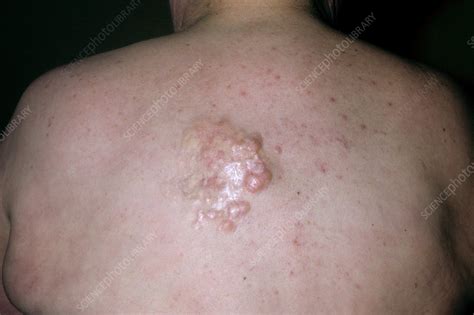Dermatofibrosarcoma Protuberans Stock Image C051 5144 Science Photo Library