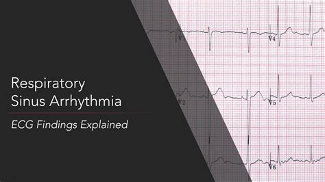 Respiratory Sinus Arrhythmia Ecg Youtube