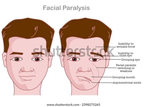 Facial Paralysis Bell Palsy Drooping Eyes Stock Vector Royalty Free