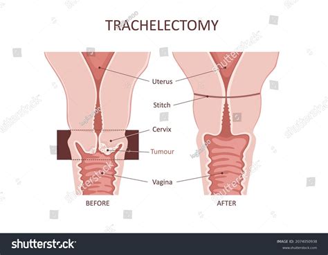 Trachelectomy Surgery Removal Cervix Before After Vetor Stock Livre
