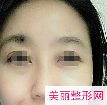 东莞市人民医院医学美容科祛痣怎么样真人案例及收费明细一览 美嘉整形网 美学知识