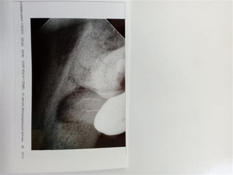 Киста Уалять ли зуб Хирургия Форум стоматологов стоматологический форум